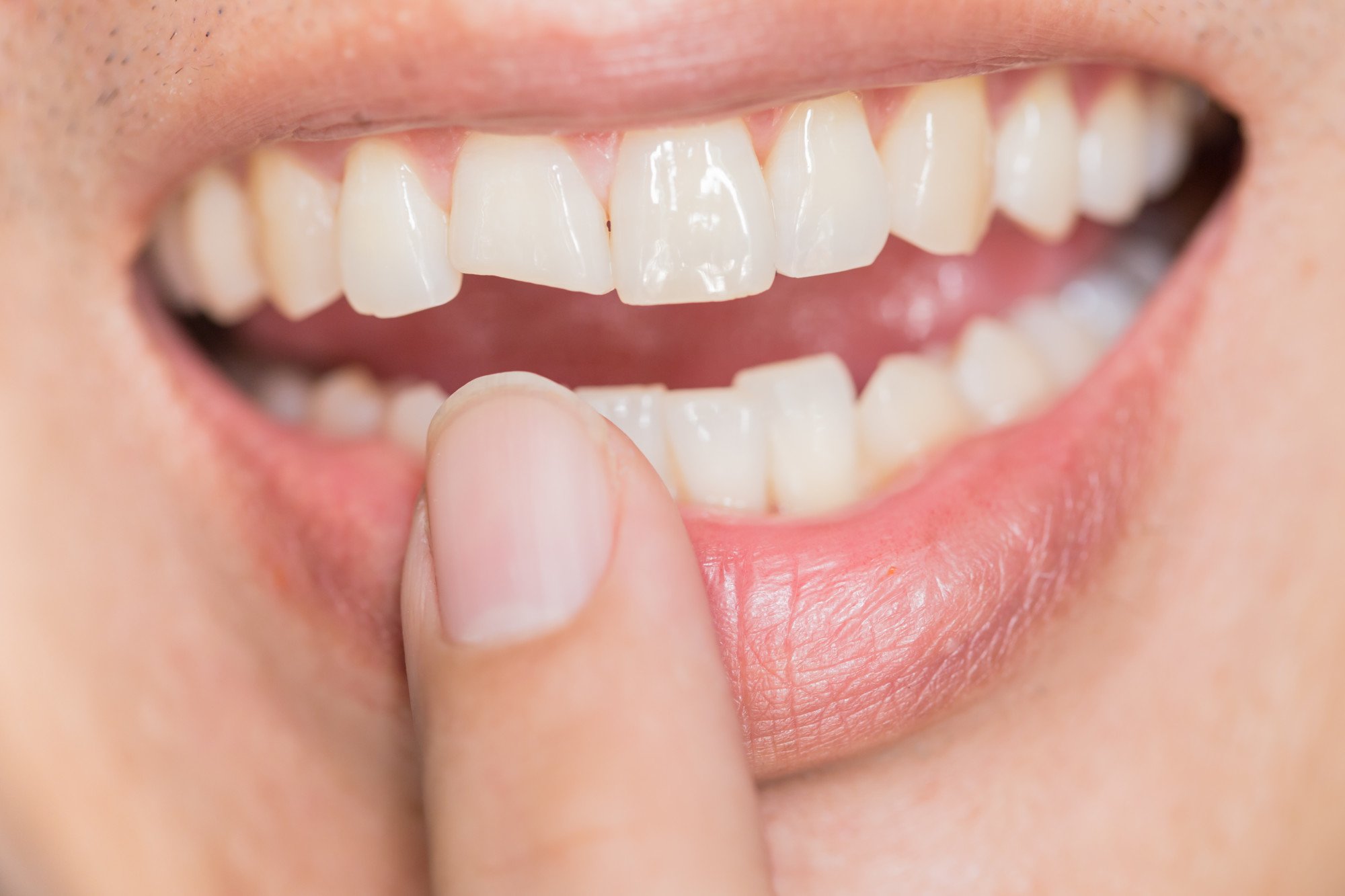 A Patient's Guide to Front Tooth Replacement Options - Embrace OM